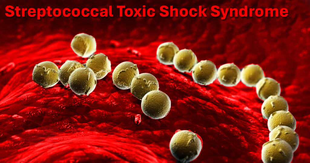 Streptococcal Toxic Shock Syndrome (STSS) - Chinmaya IAS Academy ...